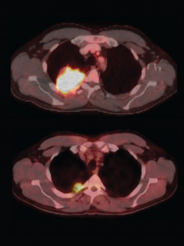 Dual Therapy's One-Two Punch Knocks Out Drug-Resistant Lung Cancer ...